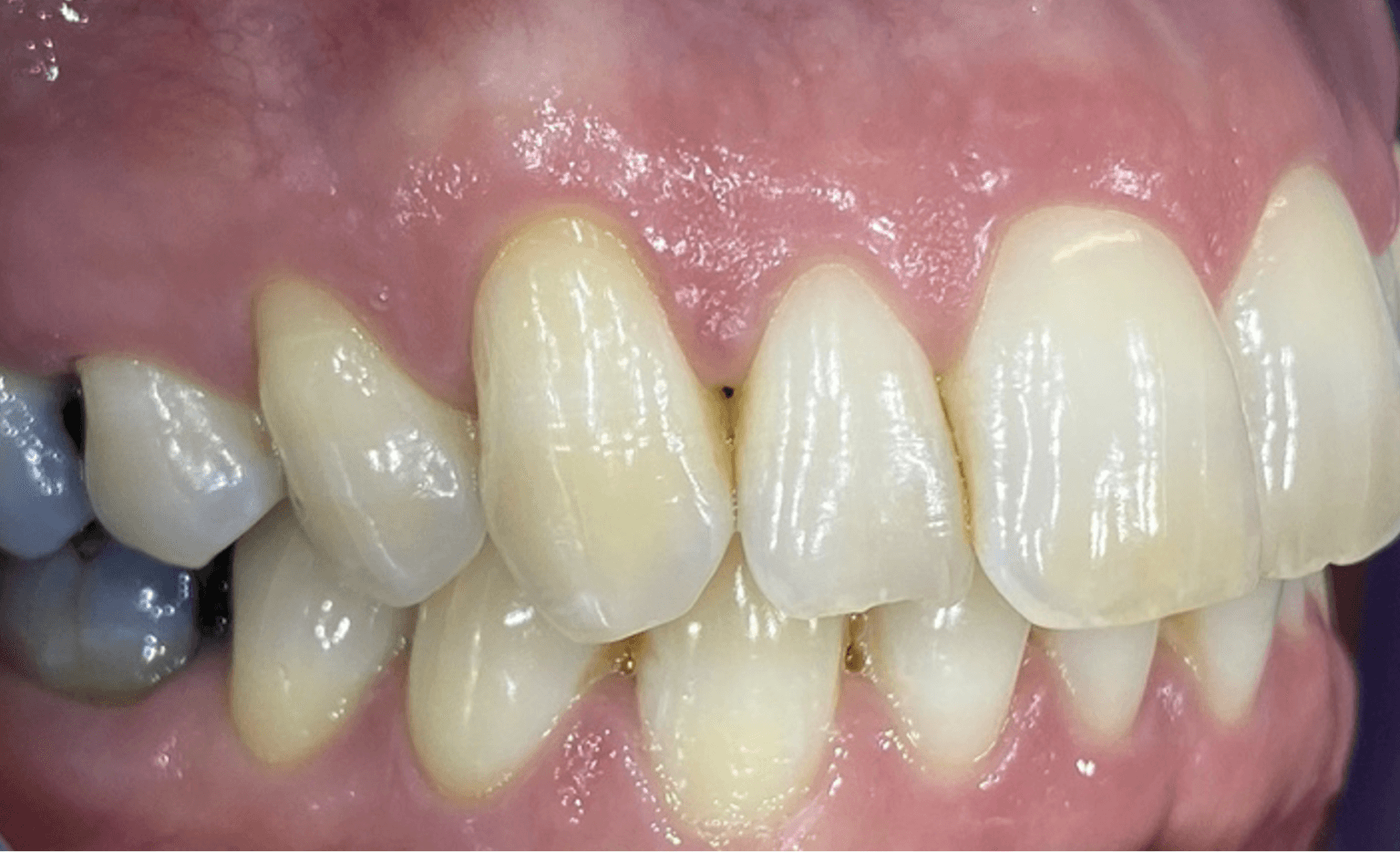 Dual arch orthodontic treatment using Clear Smile Aligners (CSA) and an ...