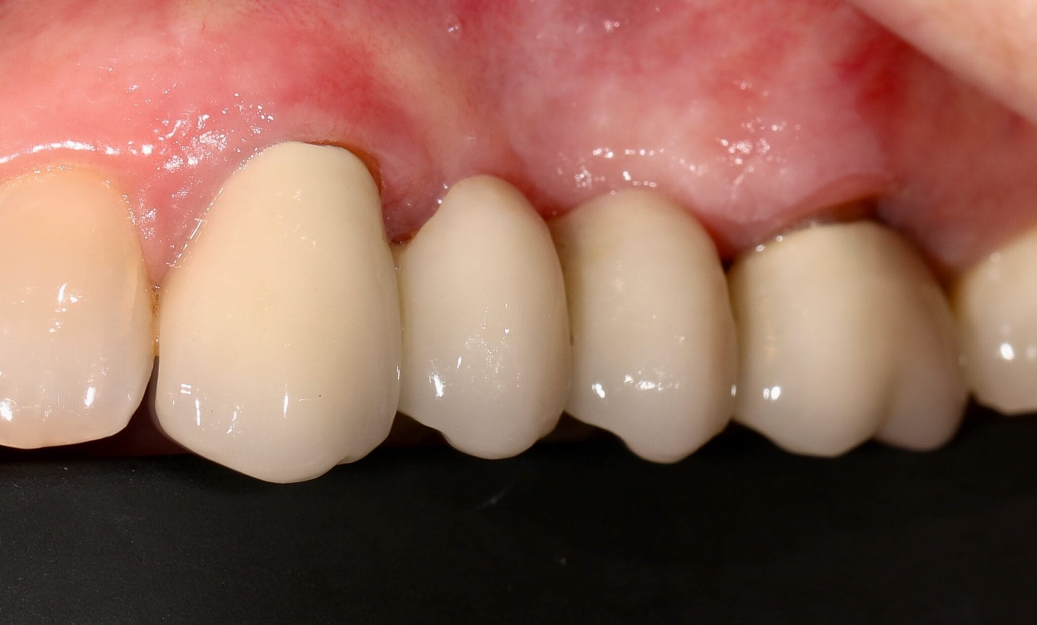 Multi-unit implant-retained prosthesis with sinus and hard tissue ...
