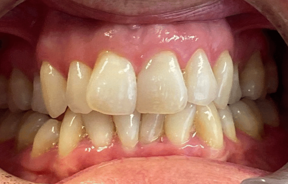 Complex crowding treated with clear aligners - The Probe