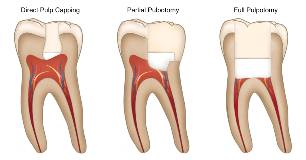 Vital Pulp Therapies in permanent teeth - The Probe
