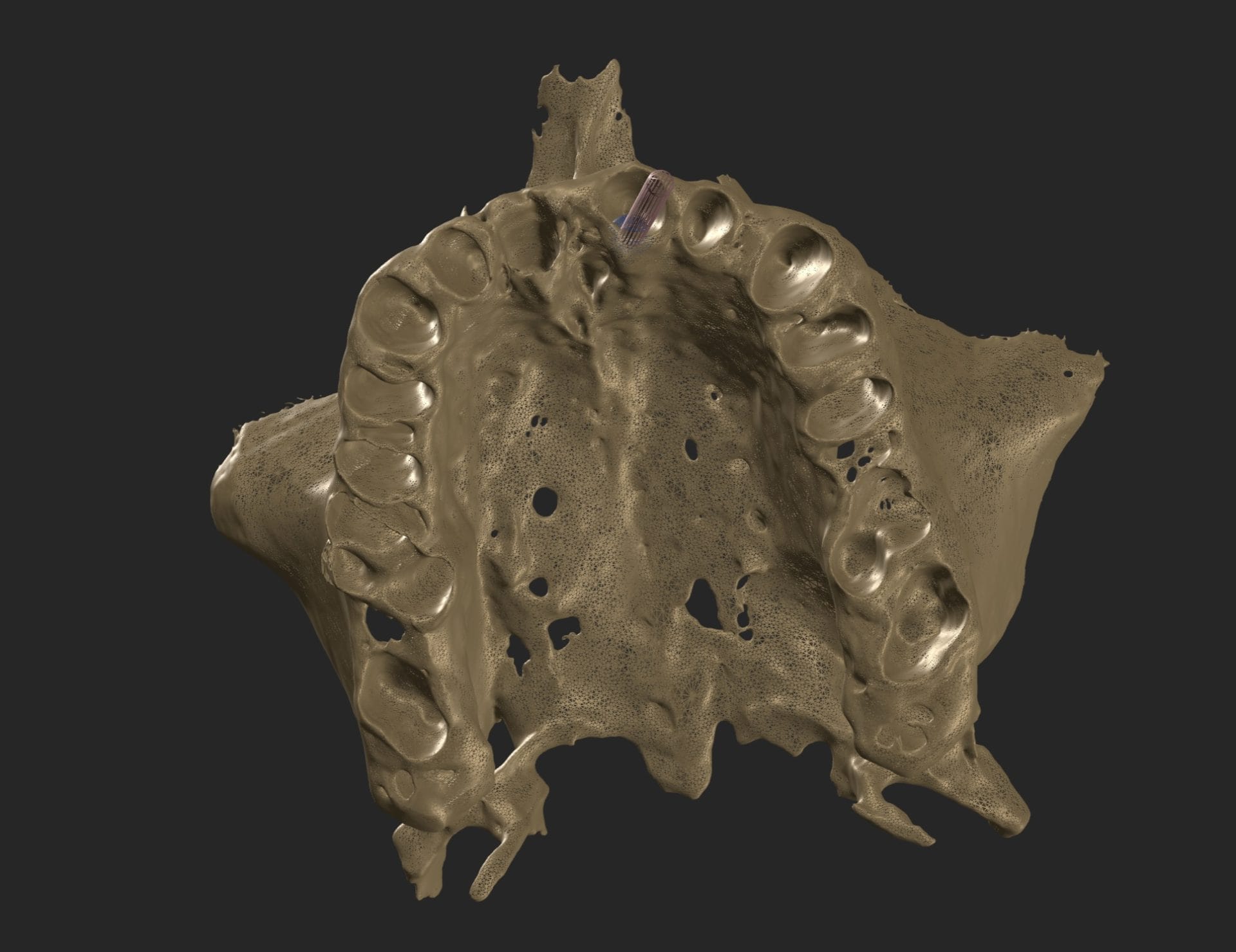 Immediate loading of an anterior maxillary implant using a guided ...
