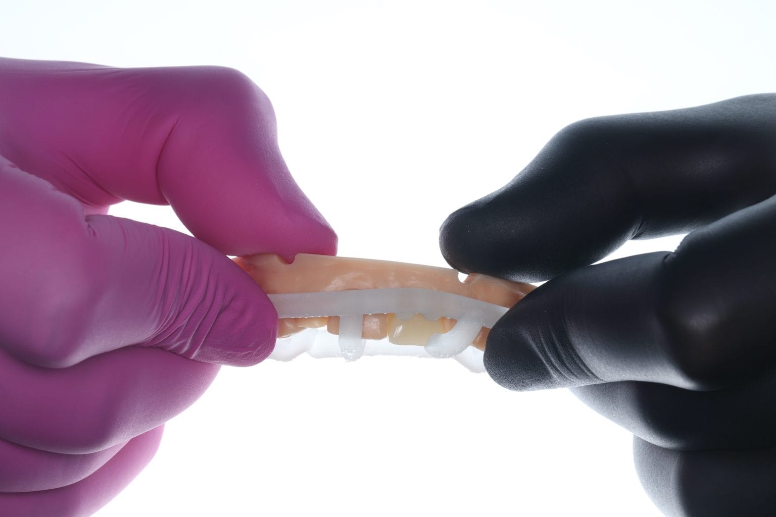 Immediate loading of an anterior maxillary implant using a guided ...